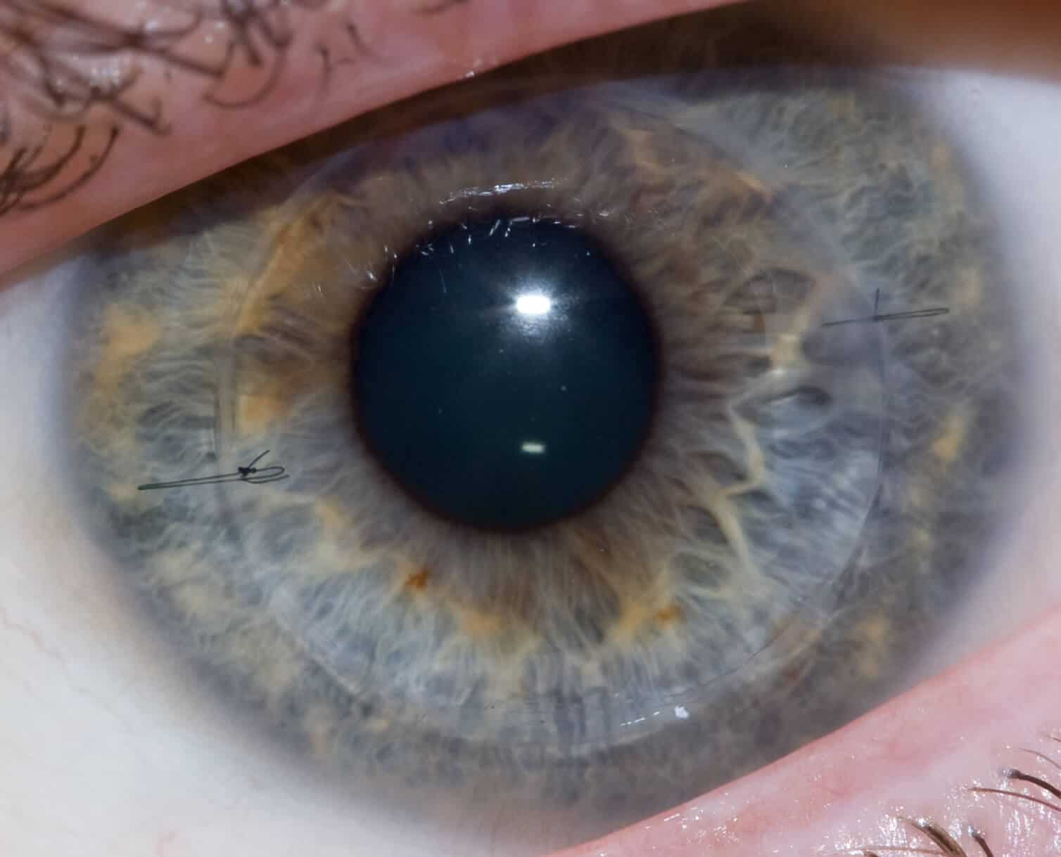 What is Fuch’s Endothelial Dystrophy? | Abraham Eye